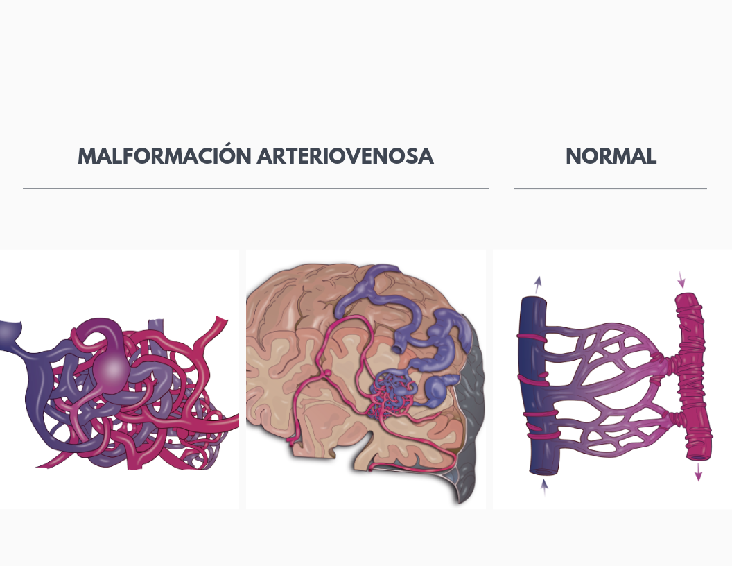 Combinación de Técnicas Neuroquirúrgicas Avanzadas para el Tratamiento ...